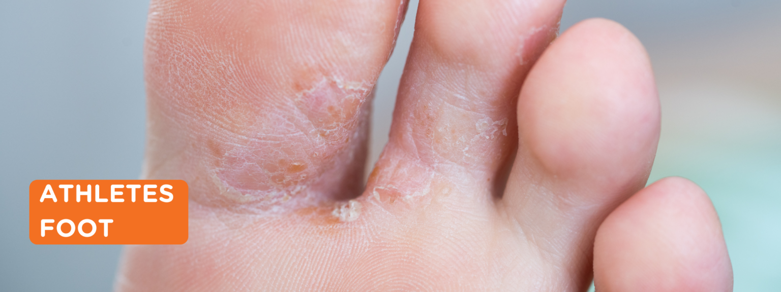Athlete’s Foot – National Feet Week